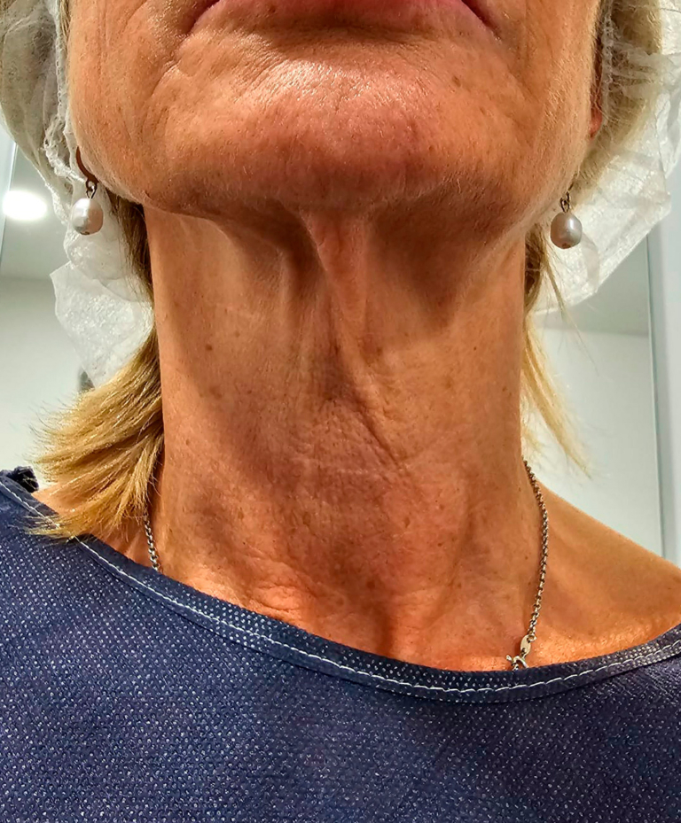 Endolift: rejuvenecimiento sin cirugía - Endolift