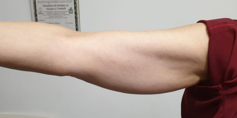 Endolift: rejuvenecimiento sin cirugía - Endolift