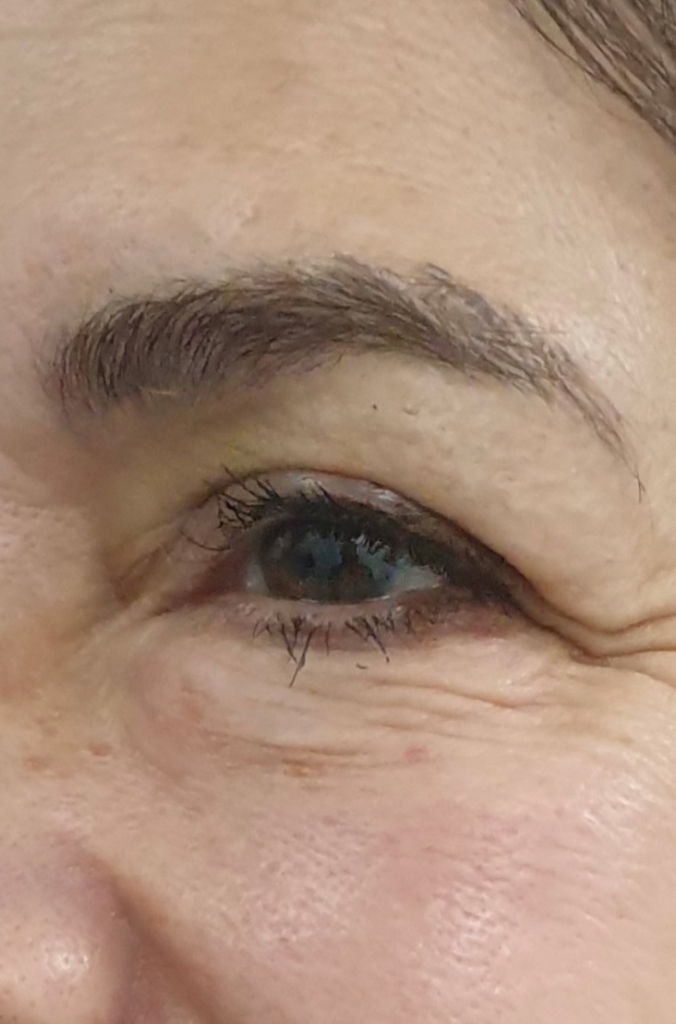 Endolift: rejuvenecimiento sin cirugía - Endolift