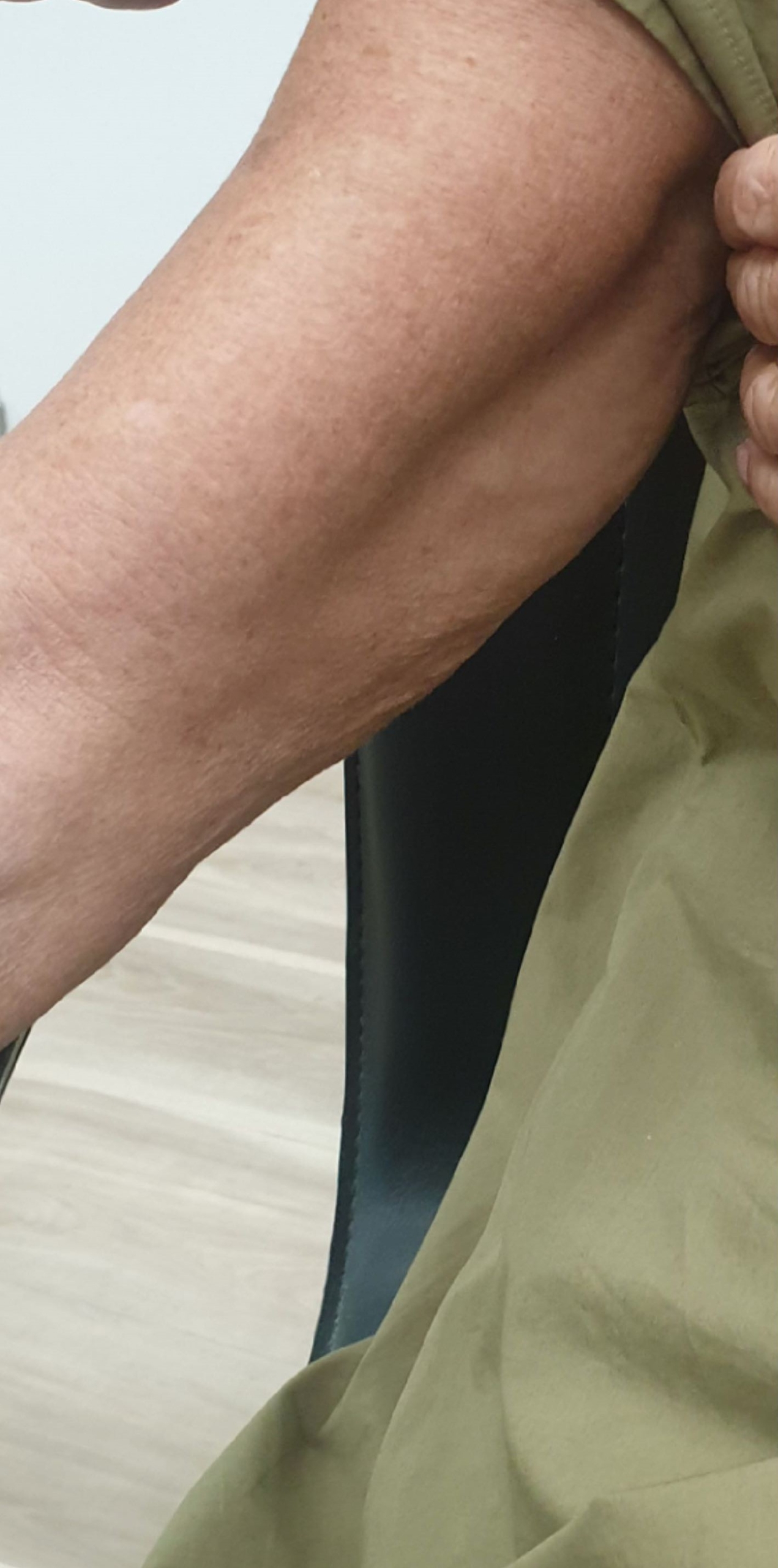 Endolift: rejuvenecimiento sin cirugía - Endolift