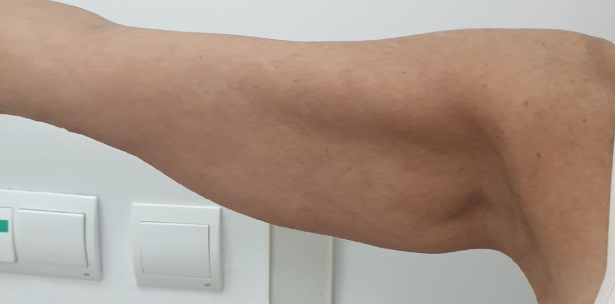 Endolift Admira Medical: Clínica médica y estética cirugía no invasiva ...